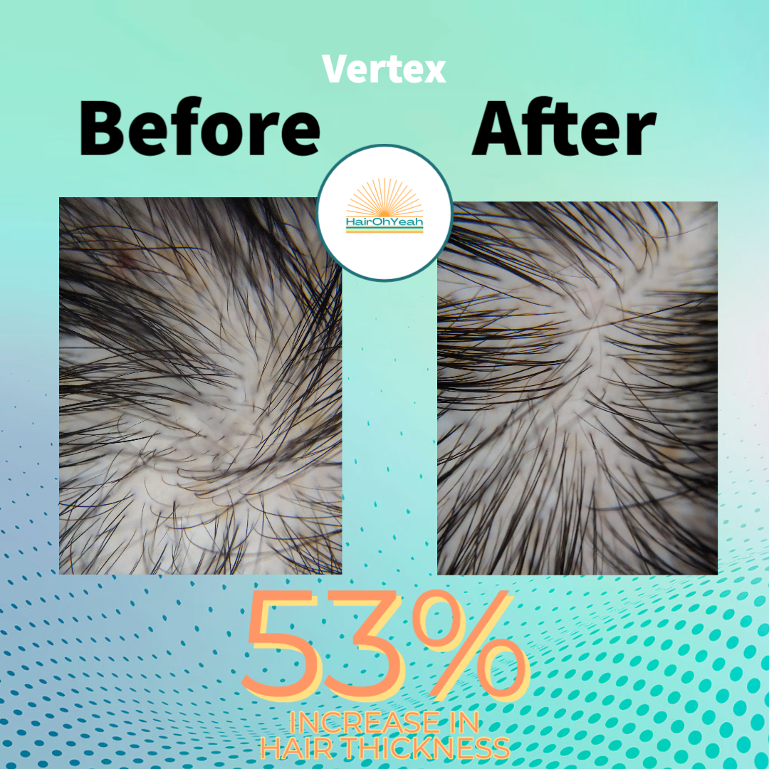 Exciting new Alma TED hair restoration treatment -benefits-proven results